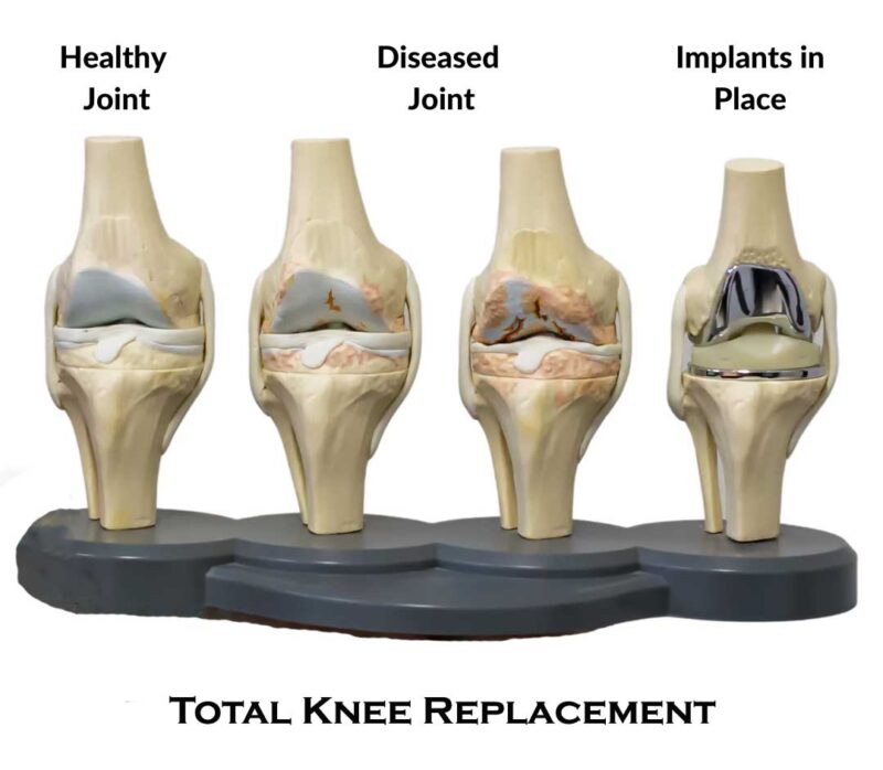 Doctor's Advice (Knee replacement) | Quill Orthopaedic Specialist Centre